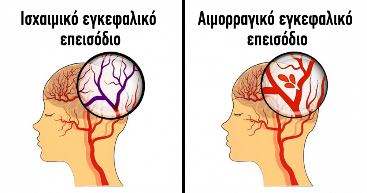 7 συμπτώματα εγκεφαλικών επεισοδίων στις γυναίκες | CityPatras