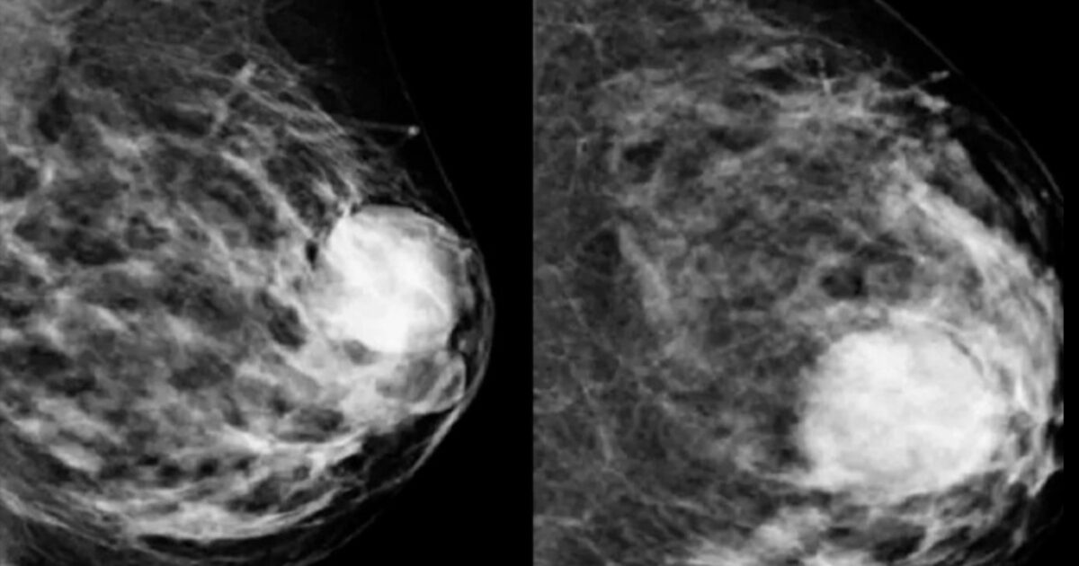 Καρκίνος του Μαστού: Συμπτώματα και Αιτίες | CityPatras